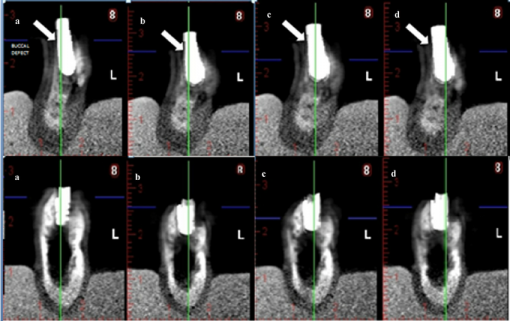 Measuring Defects on CBCT — MATLAB Number ONE