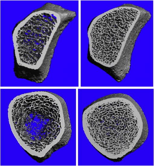 Bone microarchitecture and structure in patients with AS — MATLAB Number ONE