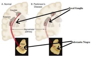 Background Information of Parkinson’s Disease — MATLAB Number ONE