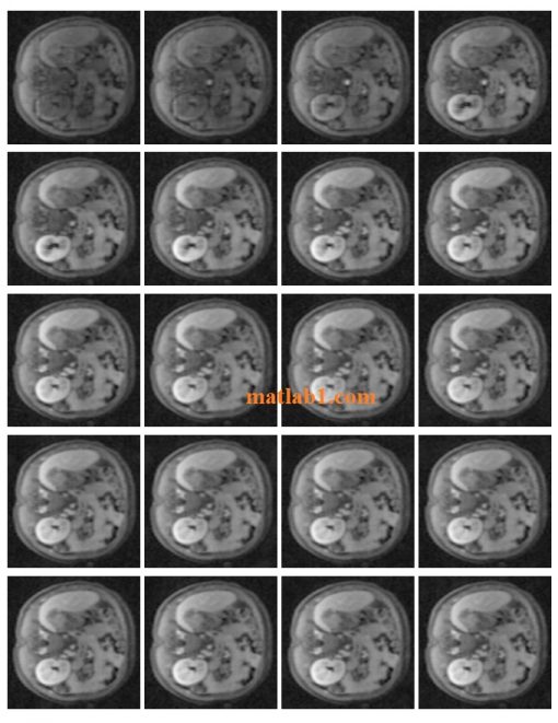 Optimal spatio-temporal undersampling techniques in dynamic MRI scenes
